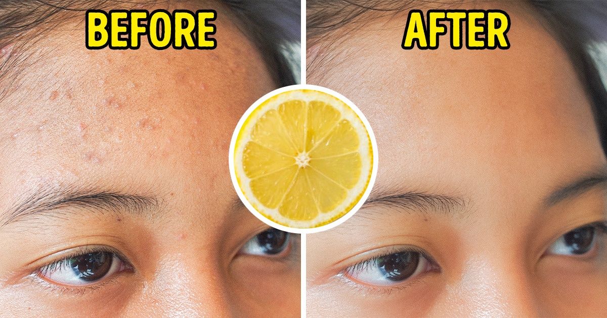9 Powerful Foods to Help Fade Acne Scars Naturally - The Amazing Times