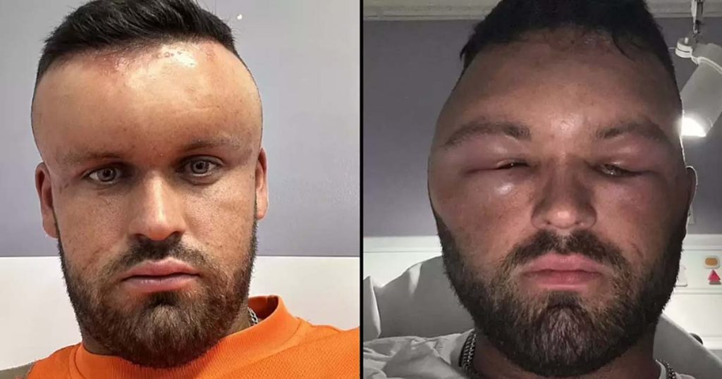 Man Ends Up Looking Like ‘Megamind’ After Having Intense Reaction To ...